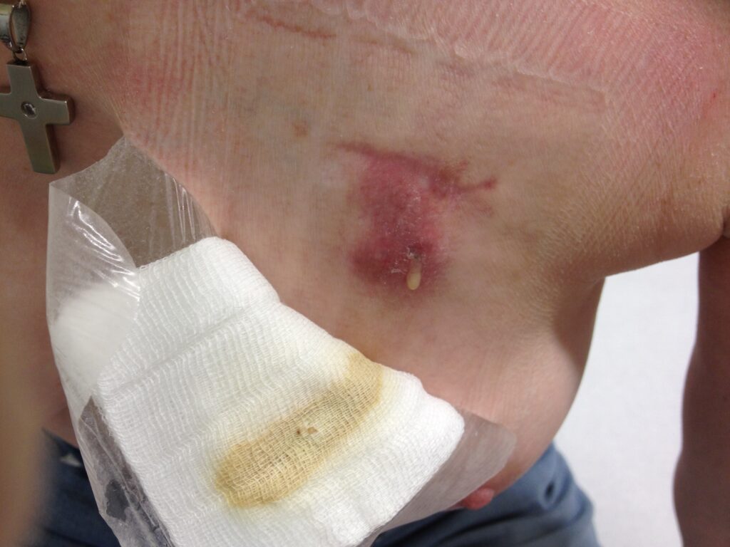 Komplikationen bei Portsystemen - Portkatheter